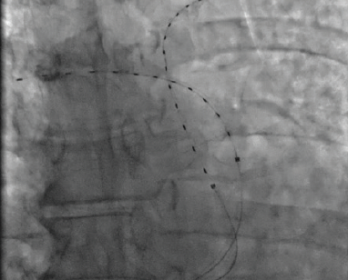 PERT Development and Implementation to Standardize Patient Pathway for ...