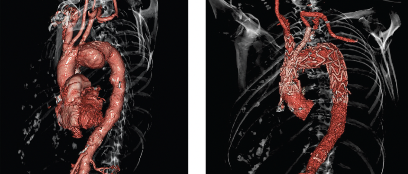 Complications and Failure Modes in the Proximal Thoracic Aorta ...