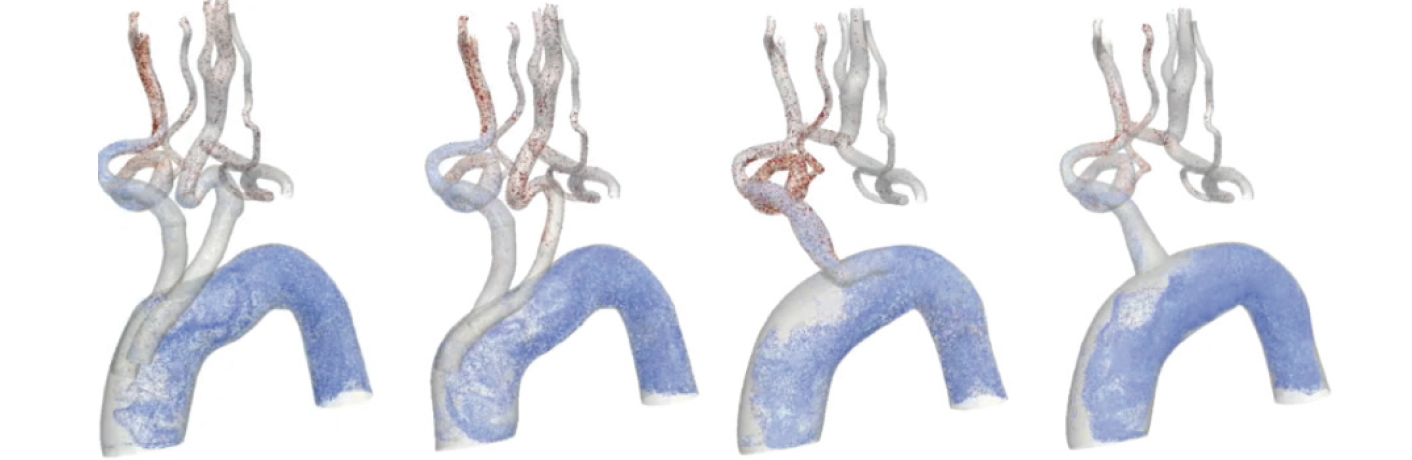 Complications and Failure Modes in the Proximal Thoracic Aorta ...