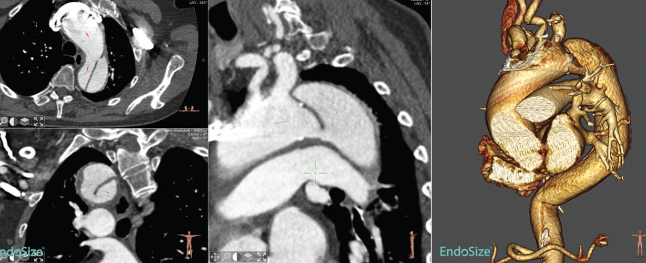 Real-World Use of the Castor™ Branched Aortic Stent Graft System for ...