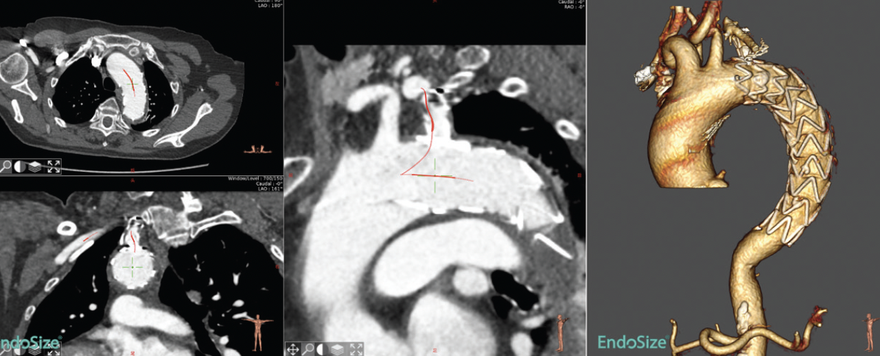 Real-World Use of the Castor™ Branched Aortic Stent Graft System for ...