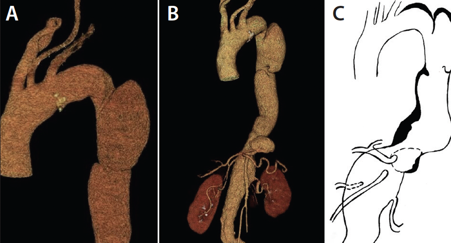 Real-World Use of the Castor™ Branched Aortic Stent Graft System for ...