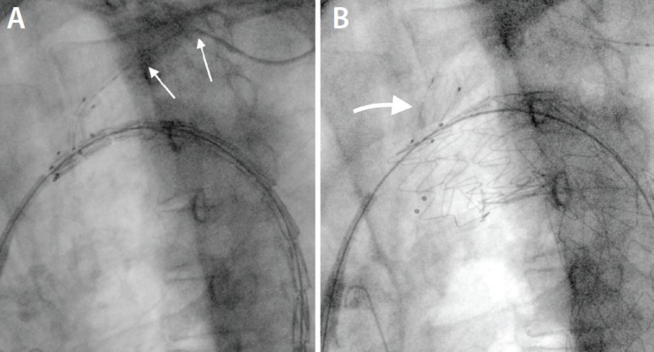 Real-World Use of the Castor™ Branched Aortic Stent Graft System for ...