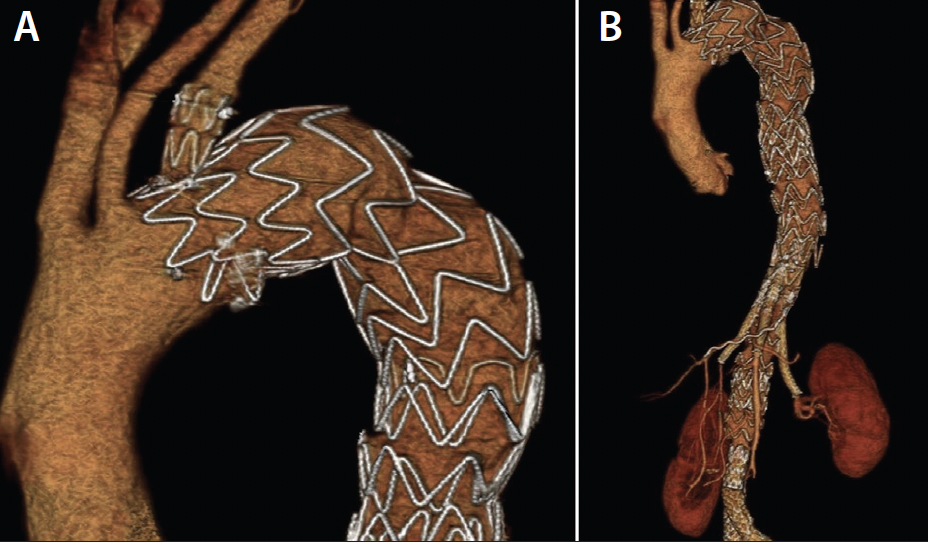 Real-World Use of the Castor™ Branched Aortic Stent Graft System for ...
