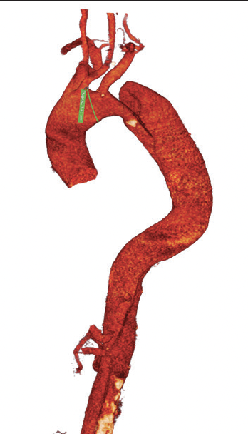 Real-World Use of the Castor™ Branched Aortic Stent Graft System for ...