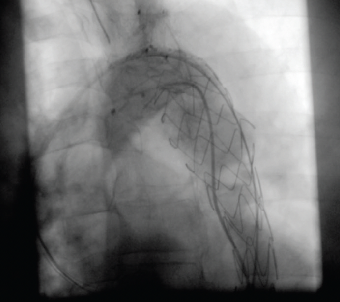 Real-World Use of the Castor™ Branched Aortic Stent Graft System for ...