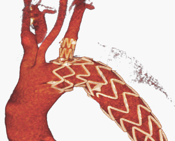 Real-World Use of the Castor™ Branched Aortic Stent Graft System for ...