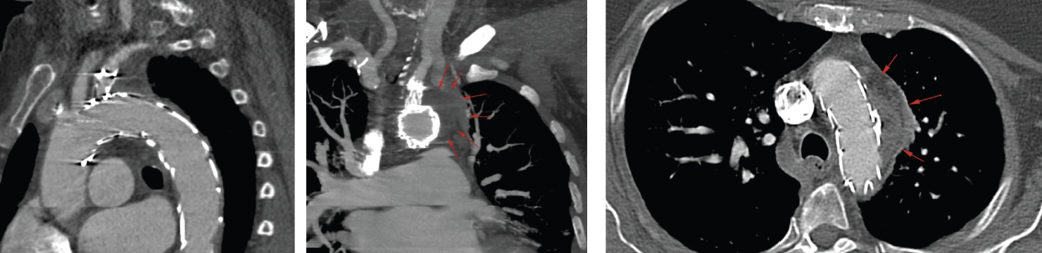 Real-World Use of the Castor™ Branched Aortic Stent Graft System for ...