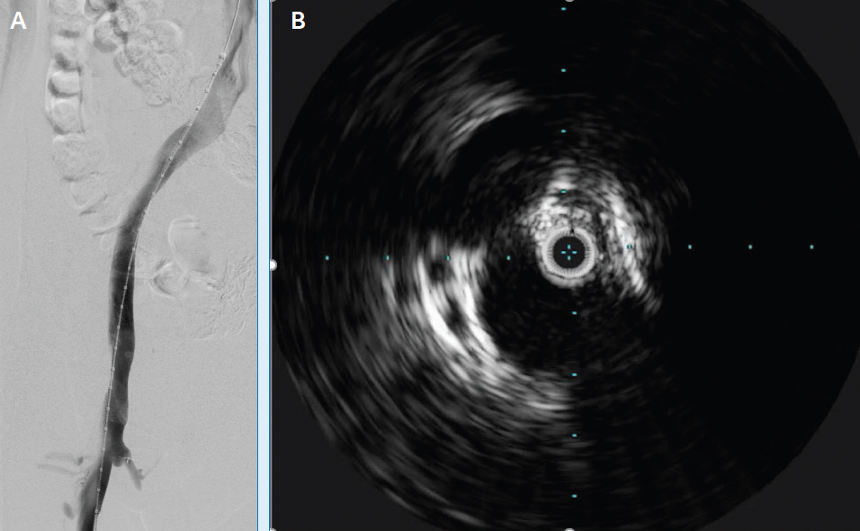 Appropriateness in Venous Stenting: A Nonthrombotic Iliac Vein ...