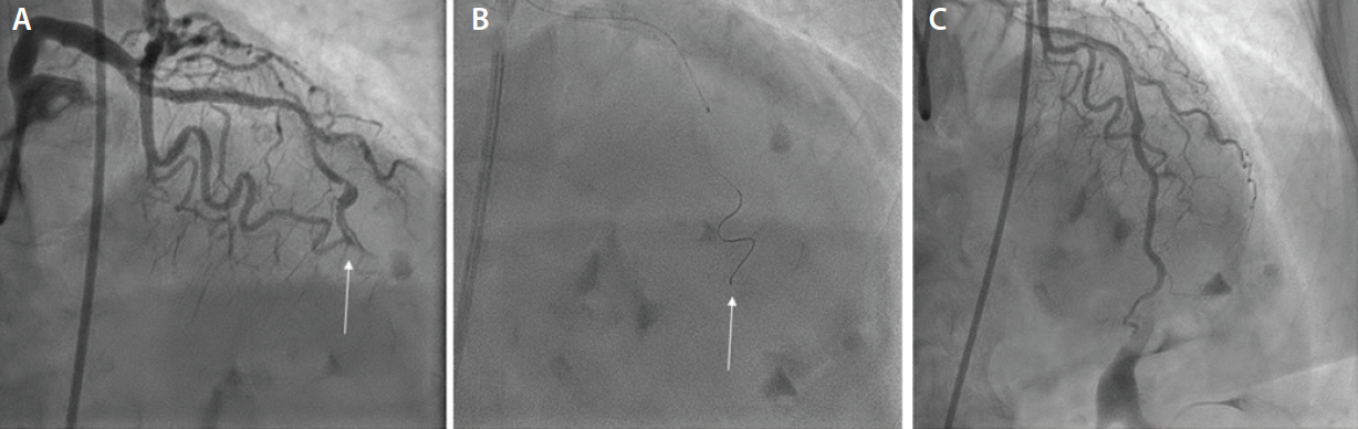 The Vessel Is Dissected and I Cannot Wire It! - Cardiac Interventions Today