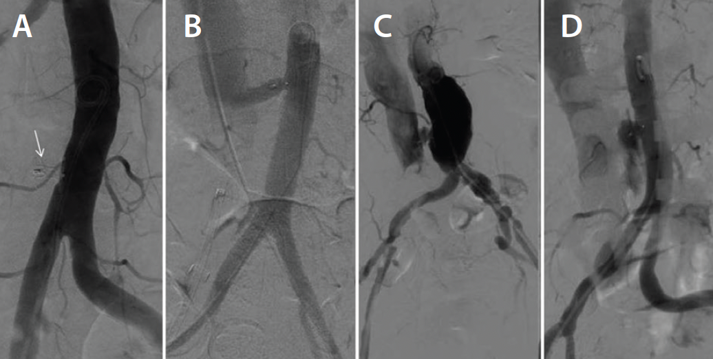 Transcaval Aortic Valve Replacement - Cardiac Interventions Today
