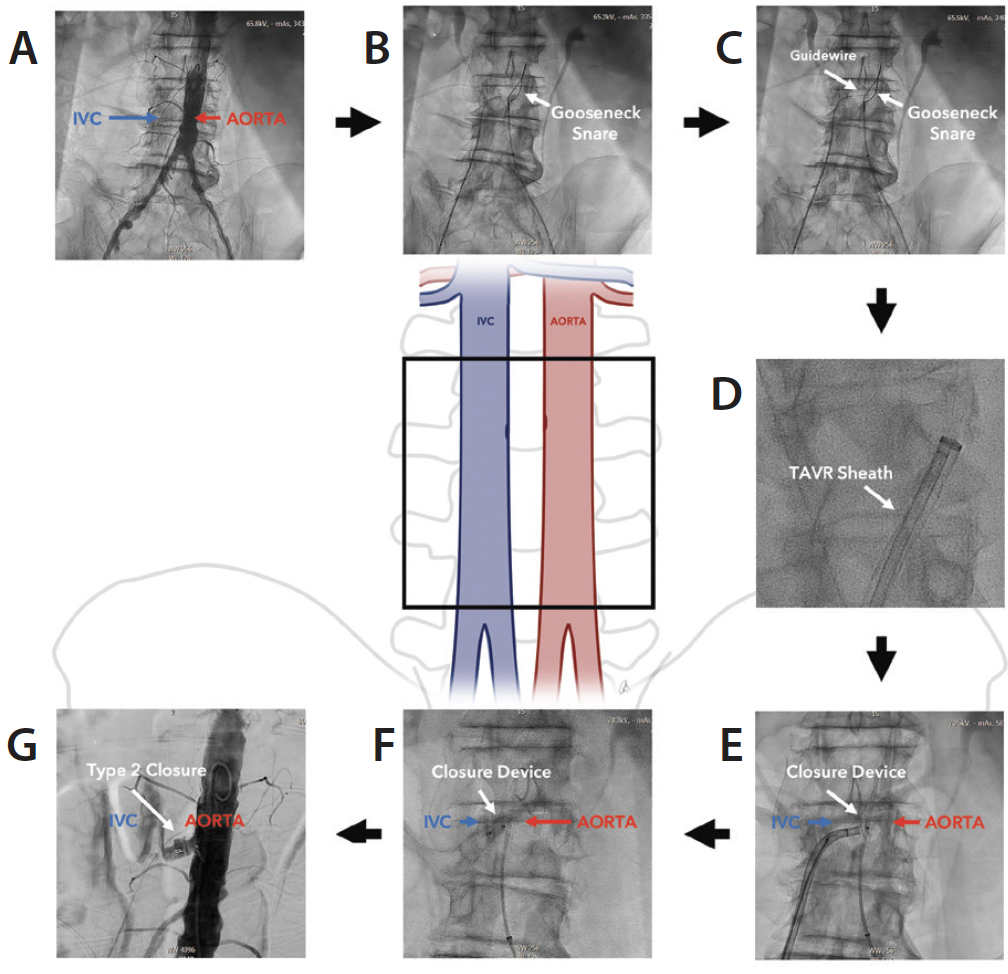 Transcaval Aortic Valve Replacement - Cardiac Interventions Today