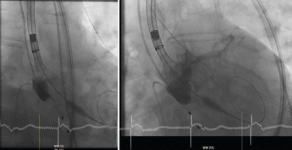 Implantation of a Self-Expandable Evolut Pro Using the Cusp Overlap ...