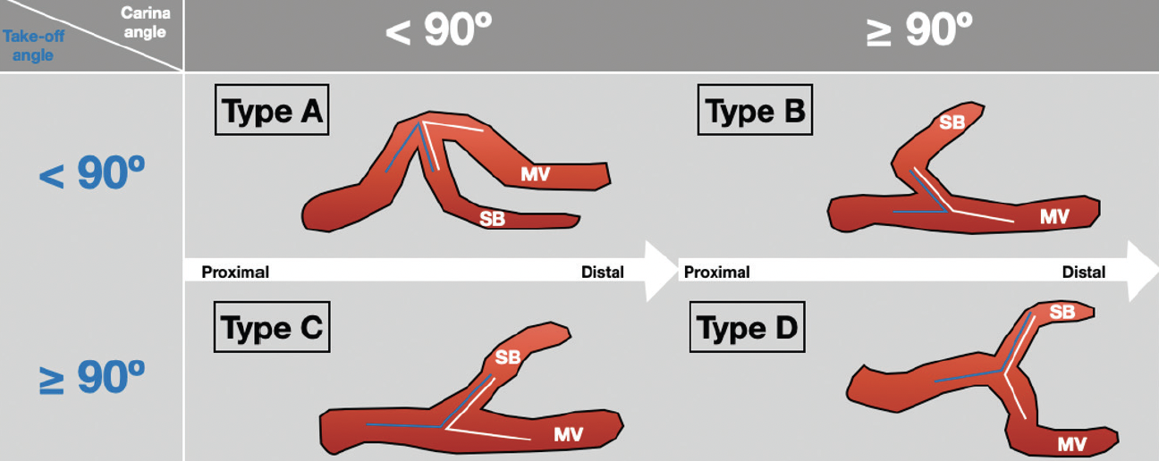 Reverse Wire Technique for Angulated Side Branches - Cardiac ...