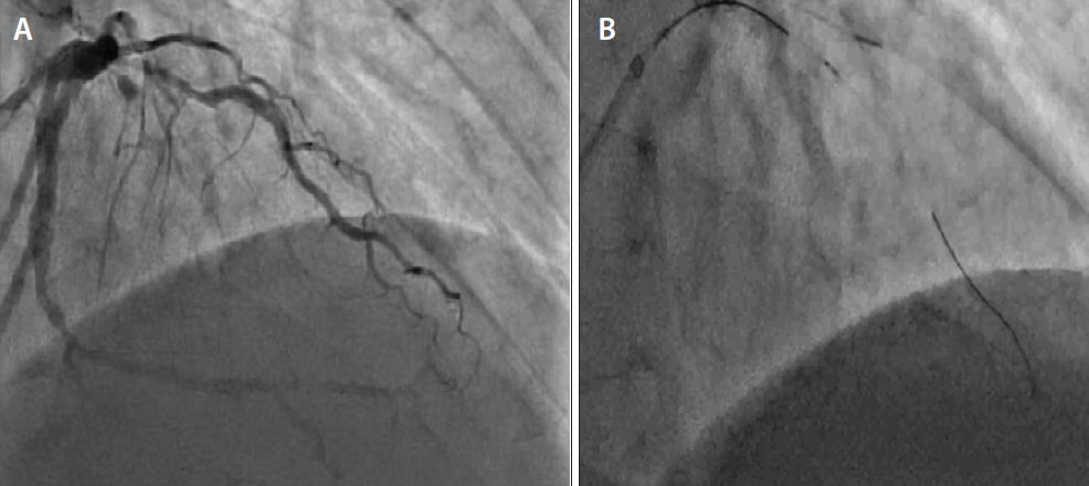 Dual Lumen Catheters: When and How to Use Them - Cardiac Interventions ...