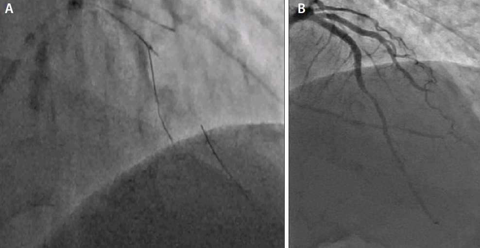 Dual Lumen Catheters: When and How to Use Them - Cardiac Interventions ...