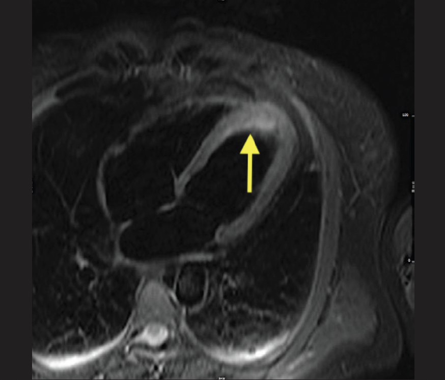 SSO2 Therapy: The Next Frontier in STEMI Care - Cardiac Interventions Today