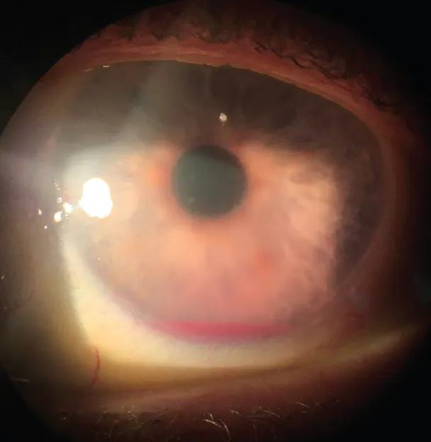 Hyphema A Novel Procedure For The Management Of Severe Hyphema After