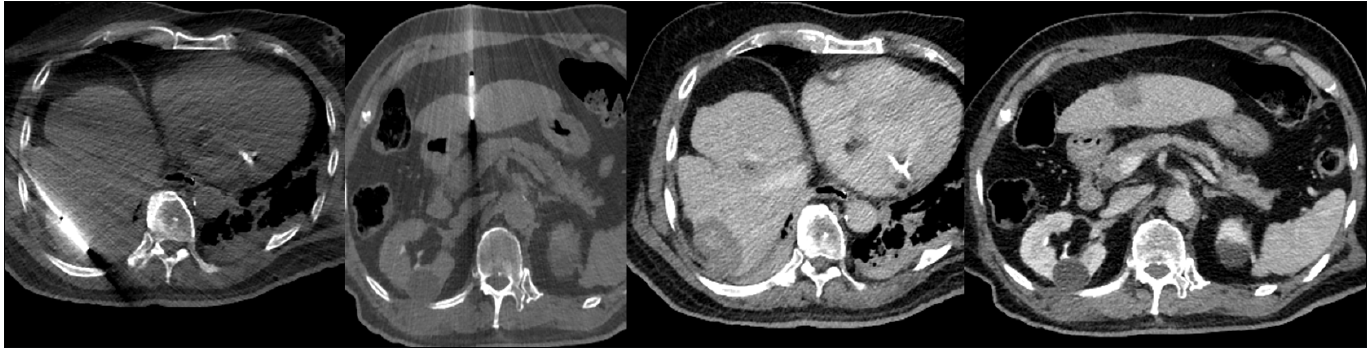Case Report: Combination Treatment of Hepatocellular Carcinoma Using ...