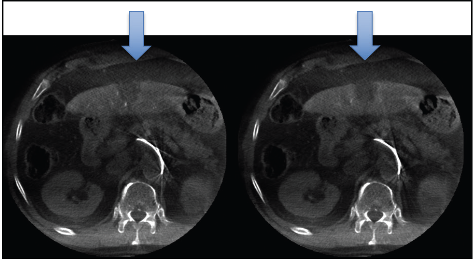 Case Report: Combination Treatment of Hepatocellular Carcinoma Using ...