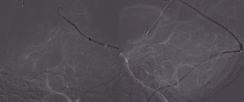 Transvenous Interventions for Arteriovenous Malformations ...