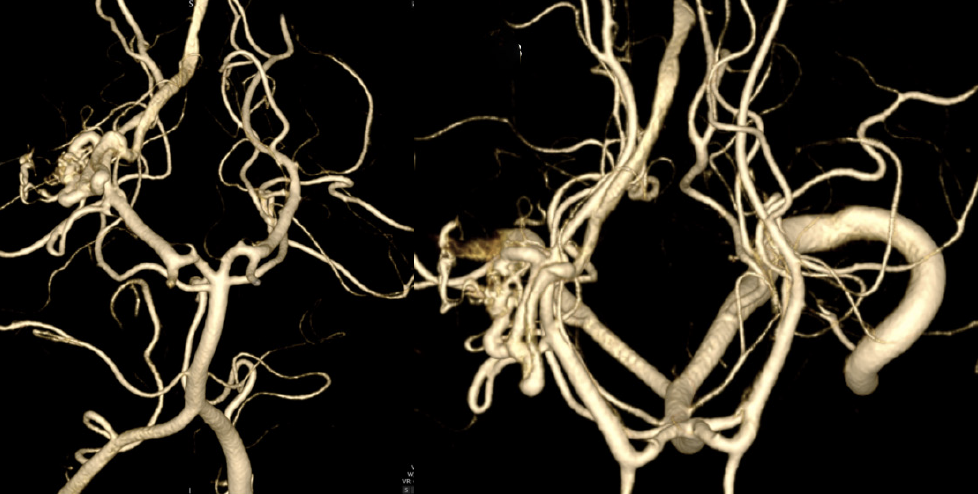 Transvenous Interventions for Arteriovenous Malformations ...