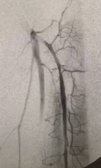 The ICHOR Reperfusion System for Clot Removal in Lower Extremity ...