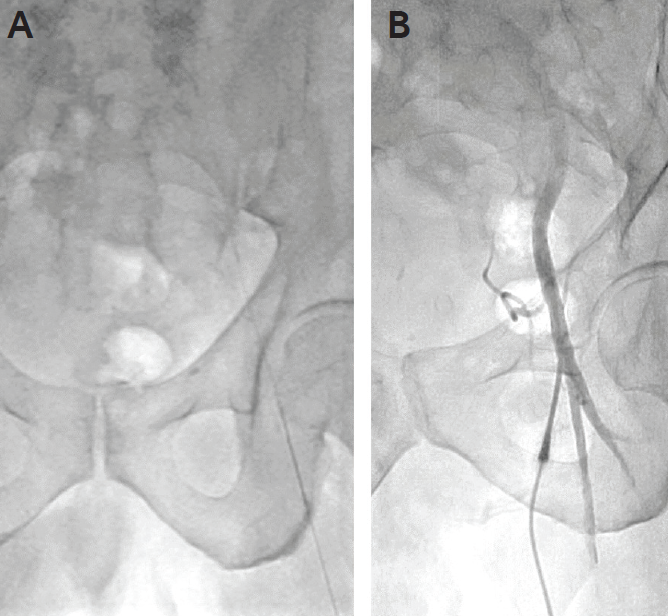 CAS Technical Considerations Using the Mo.Ma Ultra™ Proximal Cerebral ...