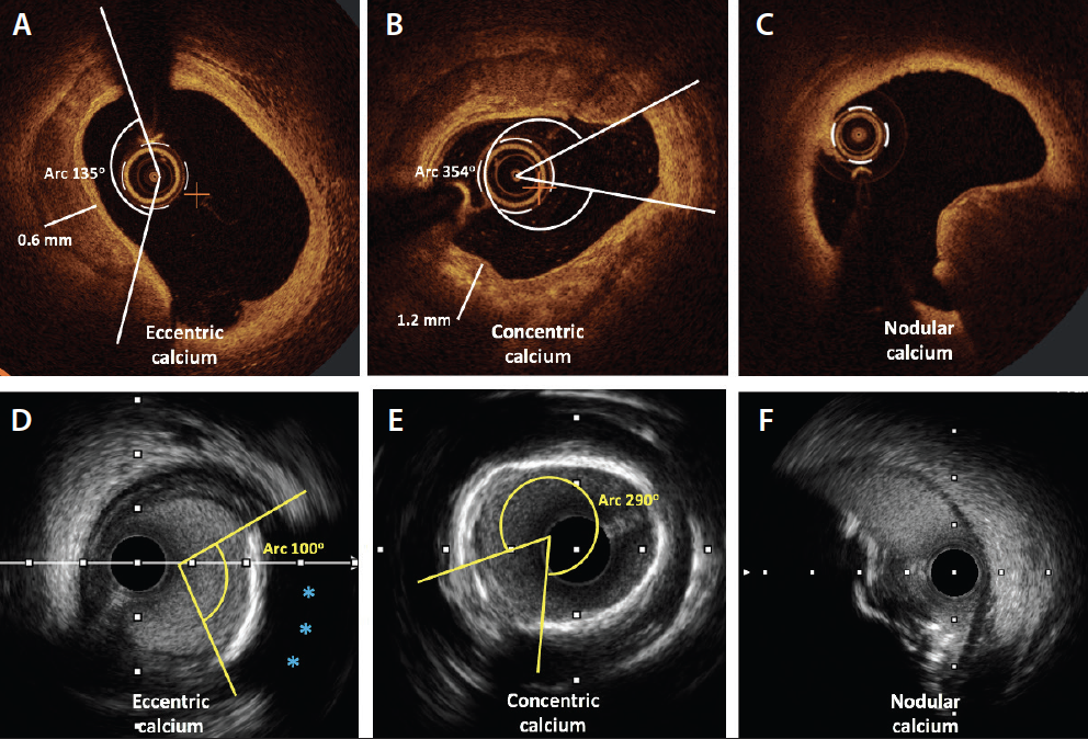 Calcium Modification: It’s All In the Preparation - Cardiac ...