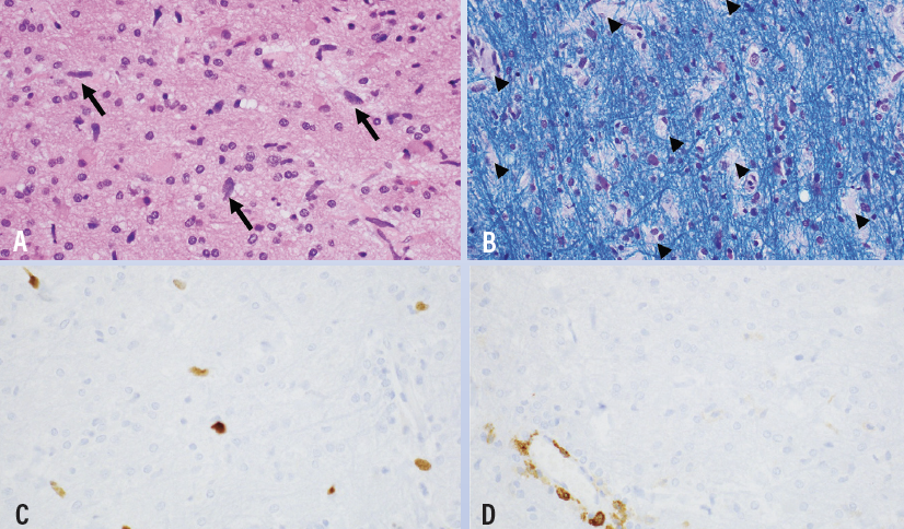 Case Conference: When ‘3-for-5’ Is Not Enough - Practical Neurology