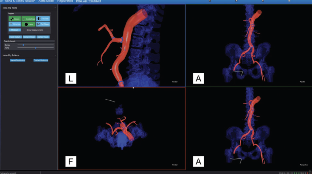 Use of the Intraoperative Positioning System for Aortic Interventions ...