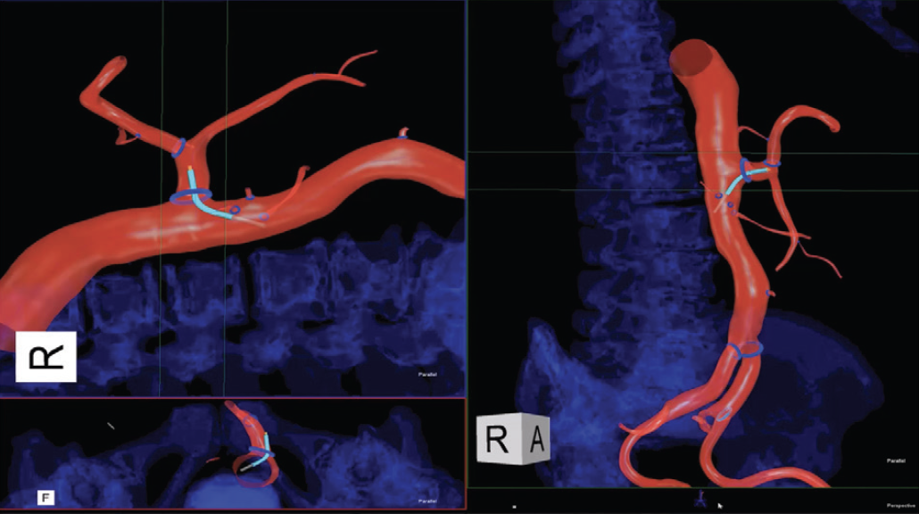 Use of the Intraoperative Positioning System for Aortic Interventions ...
