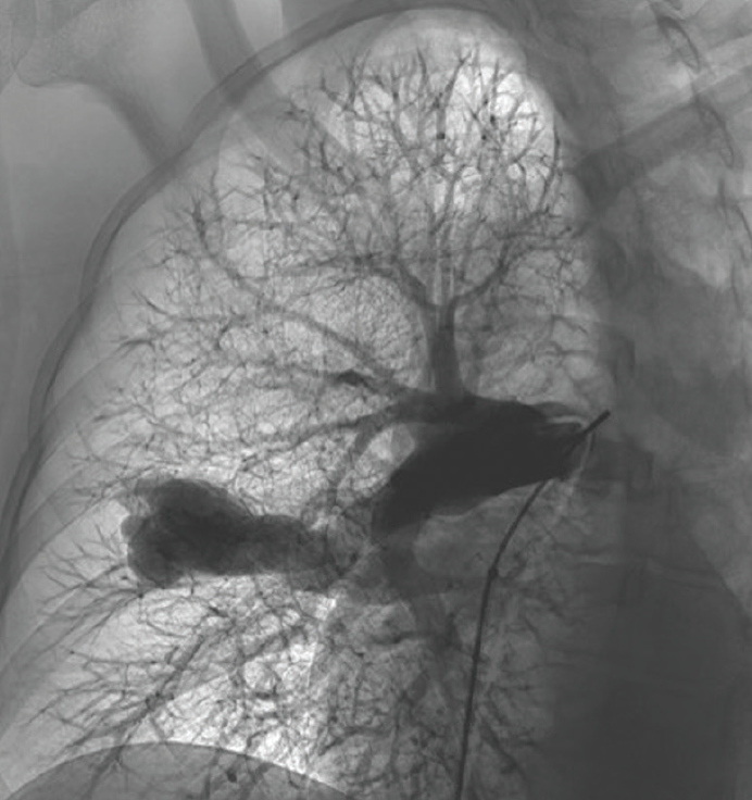 The Value of the Penumbra Large-Volume Coils in Vessel Sacrifice ...