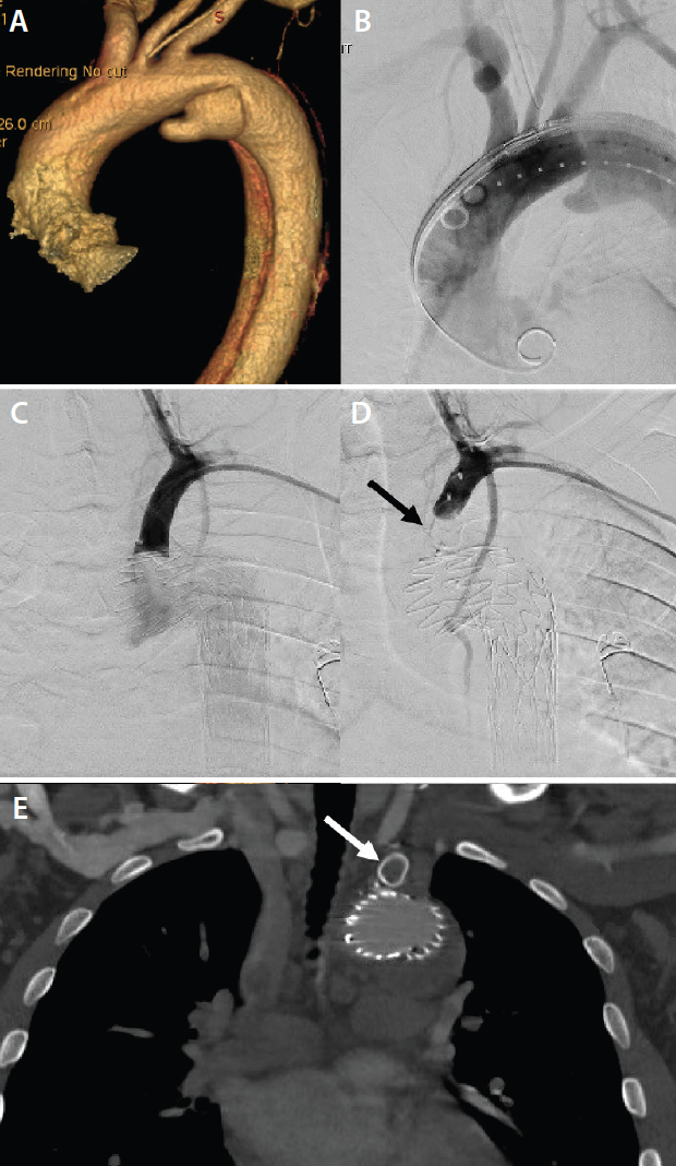 Advances in Plug Technology - Endovascular Today