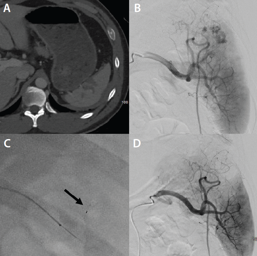 Advances in Plug Technology - Endovascular Today