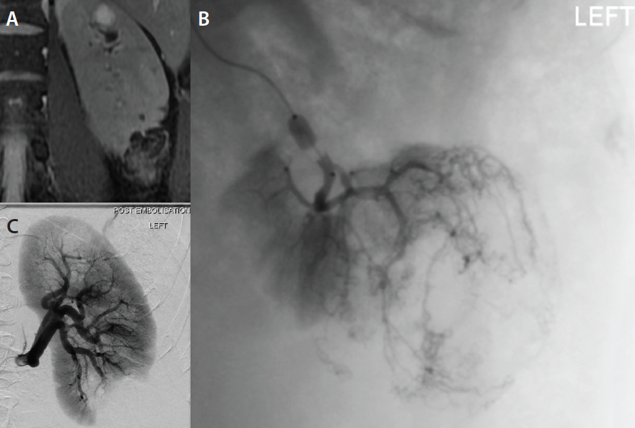 Liquid Embolics: Emerging Options and Applications - Endovascular Today
