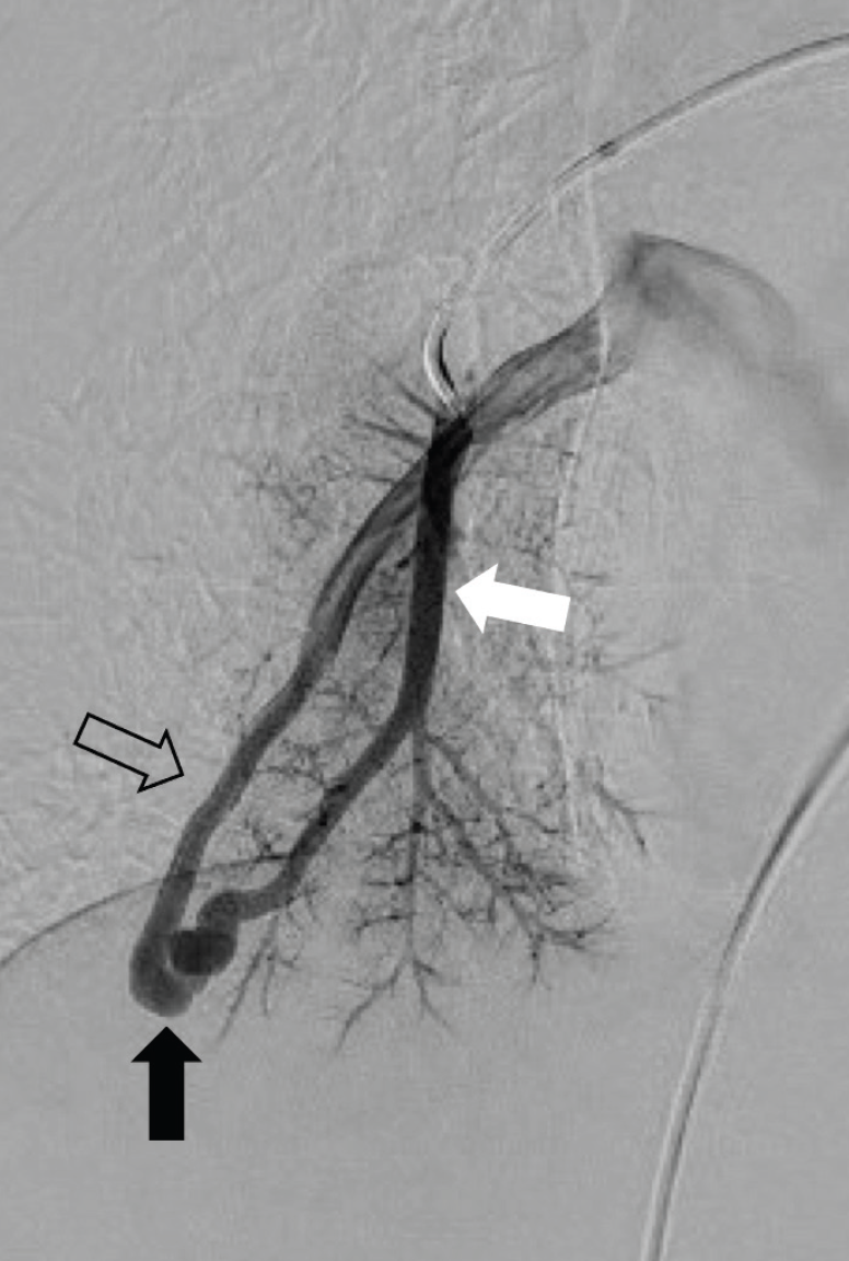 How I Do It: Pulmonary Arteriovenous Malformations: A Summary of ...