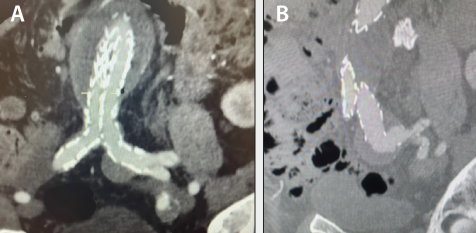 Penumbra Peripheral Embolization System: A Decade of Innovation in ...