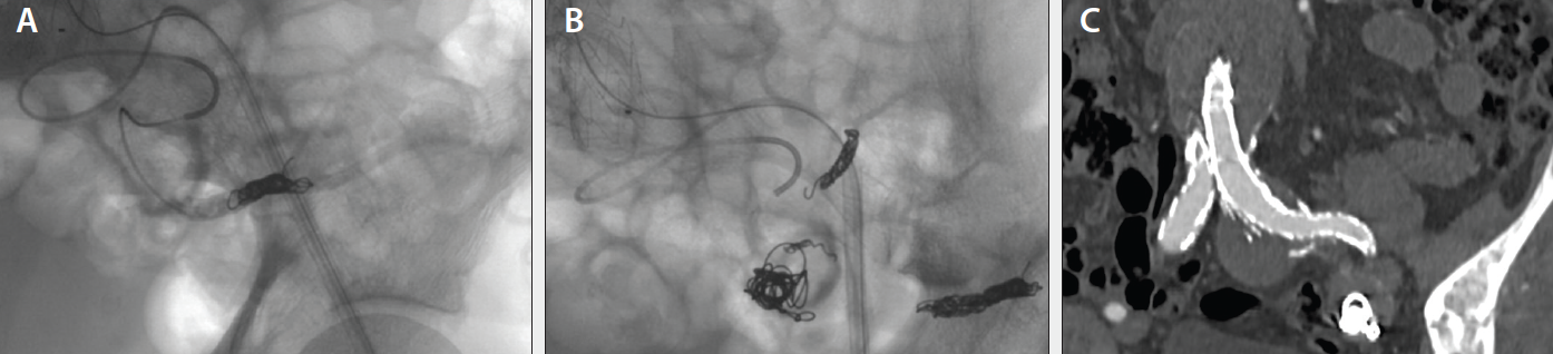 Penumbra Peripheral Embolization System: A Decade of Innovation in ...