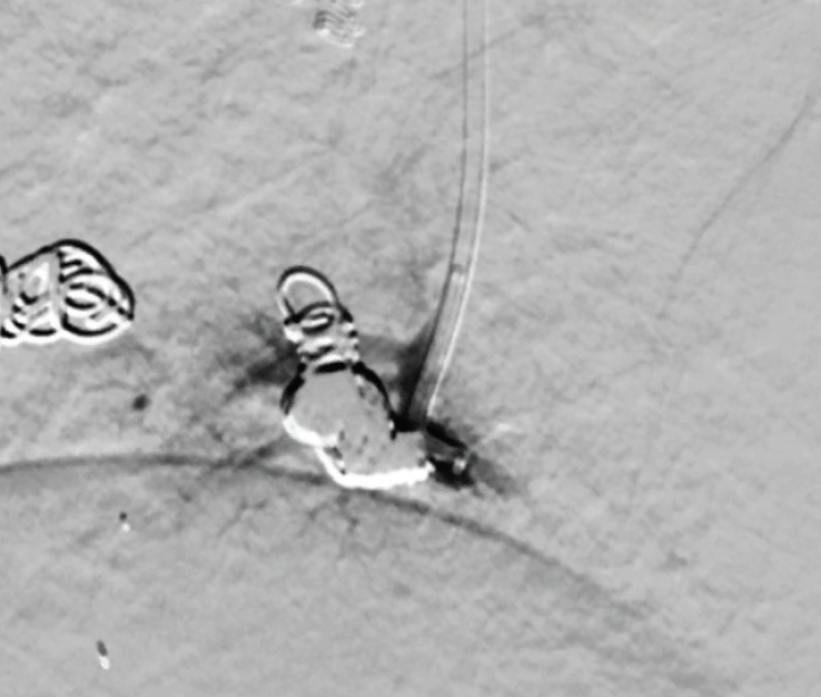 Penumbra Peripheral Embolization System: A Decade of Innovation in ...