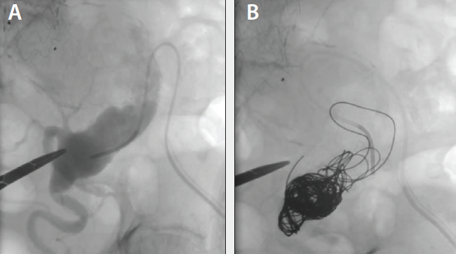Penumbra Peripheral Embolization System: A Decade of Innovation in ...