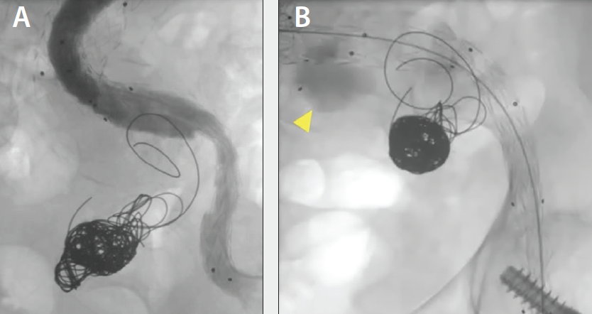 Penumbra Peripheral Embolization System: A Decade of Innovation in ...