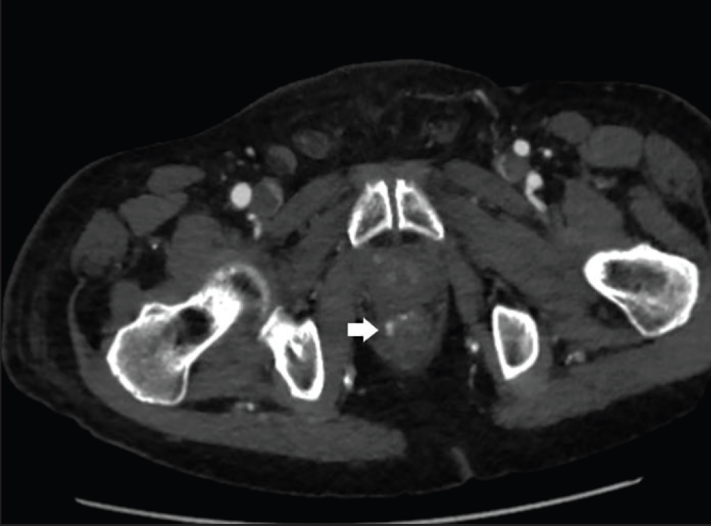 Penumbra Peripheral Embolization System: A Decade of Innovation in ...