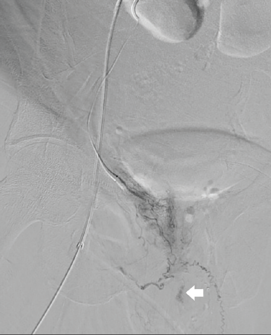 Penumbra Peripheral Embolization System: A Decade of Innovation in ...