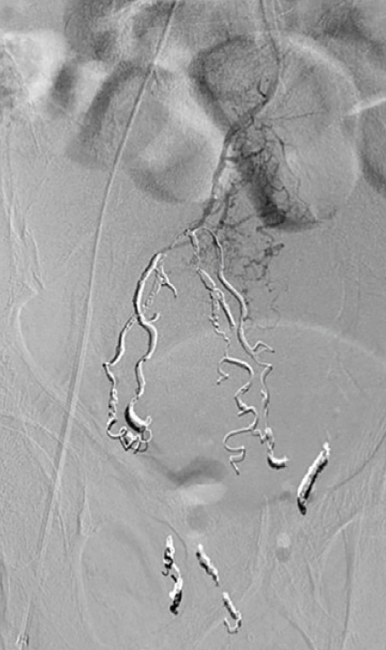 Penumbra Peripheral Embolization System: A Decade of Innovation in ...
