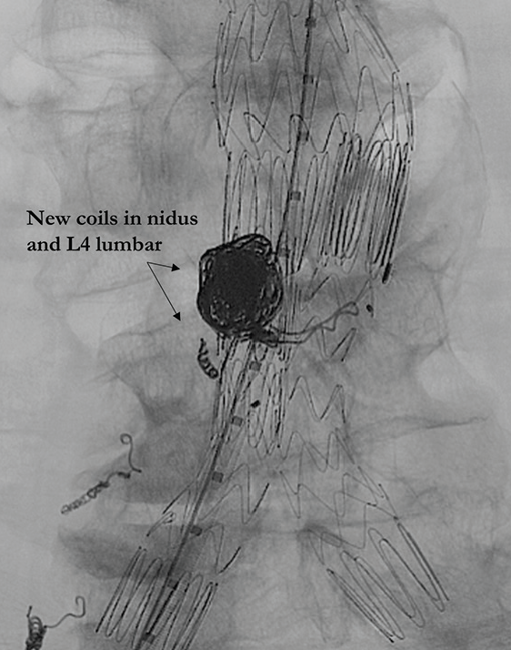 Penumbra Peripheral Embolization System: A Decade of Innovation in ...