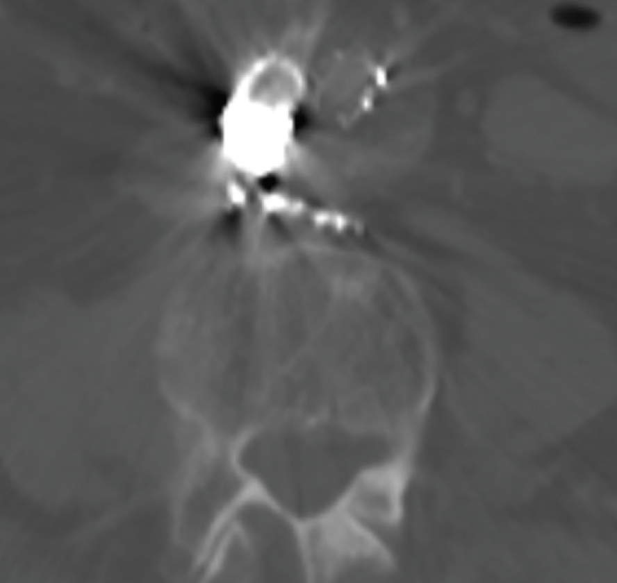 Penumbra Peripheral Embolization System: A Decade of Innovation in ...