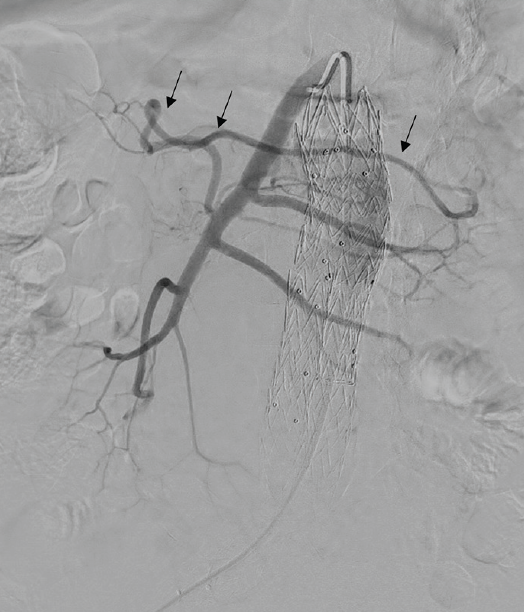 Penumbra Peripheral Embolization System: A Decade of Innovation in ...