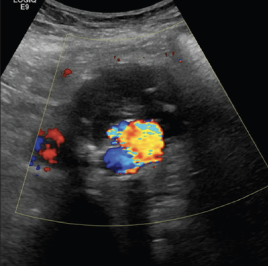 Penumbra Peripheral Embolization System: A Decade of Innovation in ...