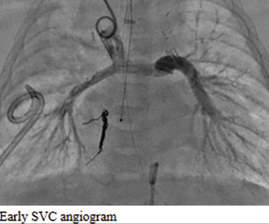 Penumbra Peripheral Embolization System: A Decade of Innovation in ...
